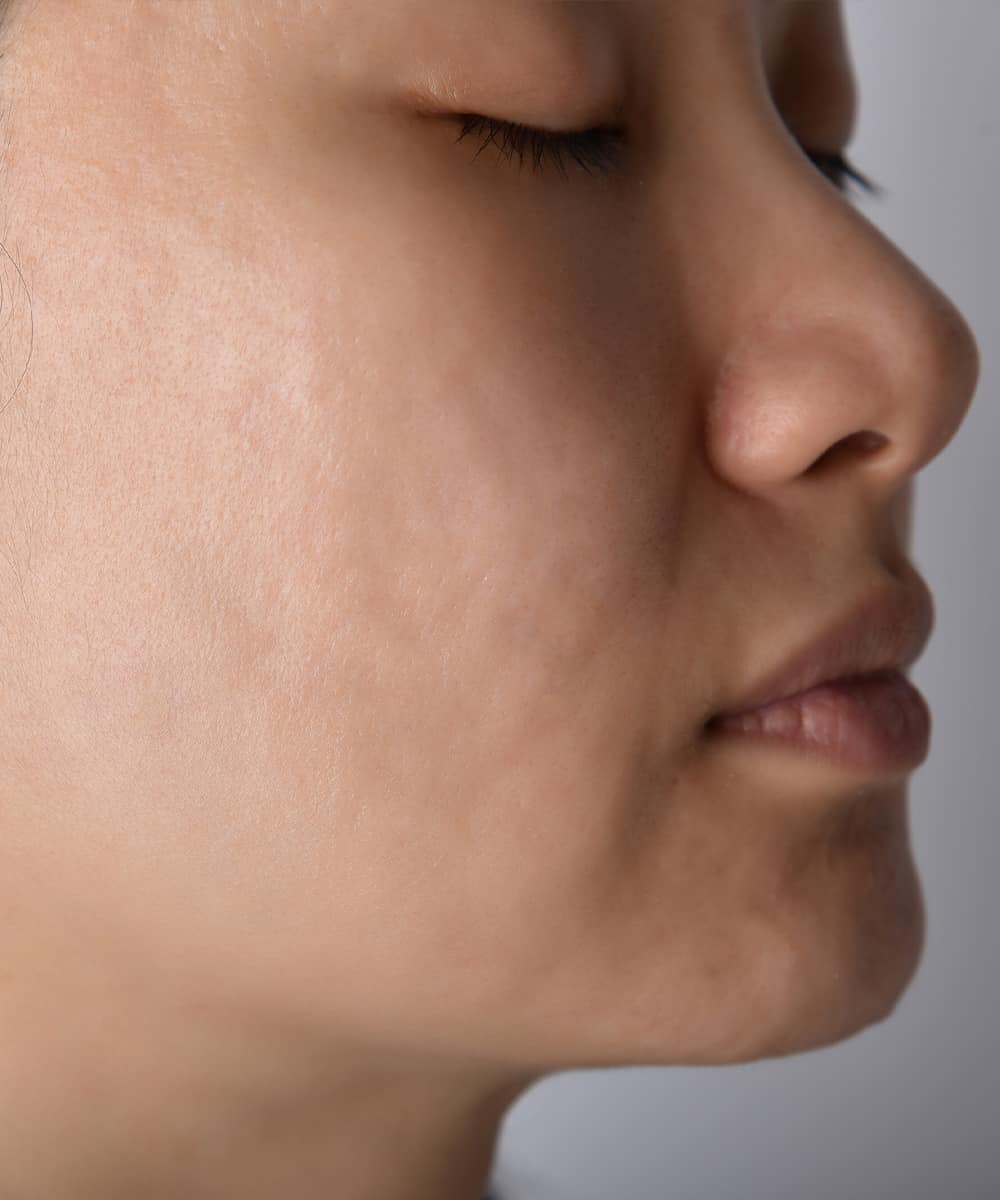 Trichloroacetic Acid Cross Treatment In Malaysia - Neya Clinic